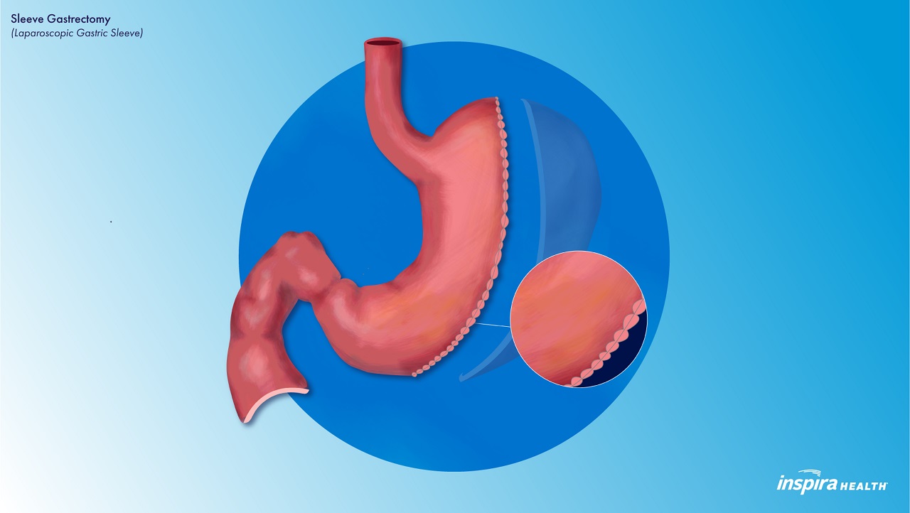 Sleeve Gastrectomy (Gastric Sleeve) | Inspira Health